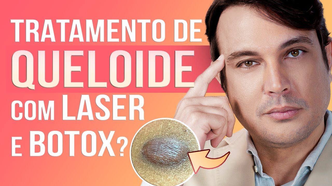 Tratamento de Queloides com laser de CO2 e Botox - YouTube