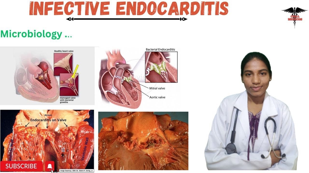 Infective Endocarditis || Cardiovascular Microbiology | Chill Medicos ...