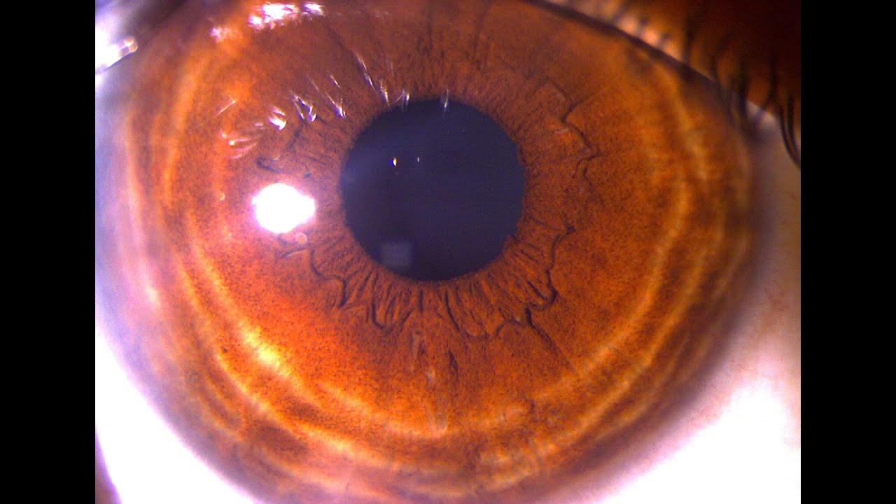 Managing Myopic Anisometropia with ICL by Prof Amer Awan - YouTube