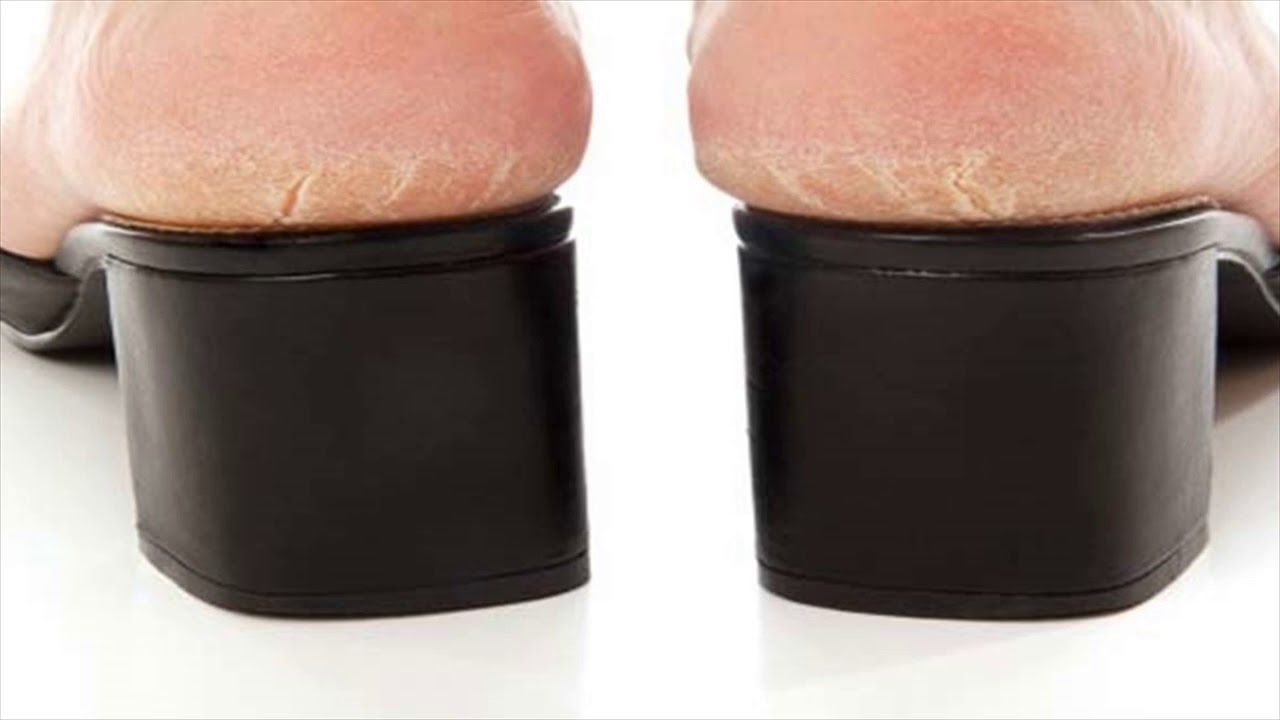 What Causes Cracked Heels- Reasons For Cracked Heels - YouTube