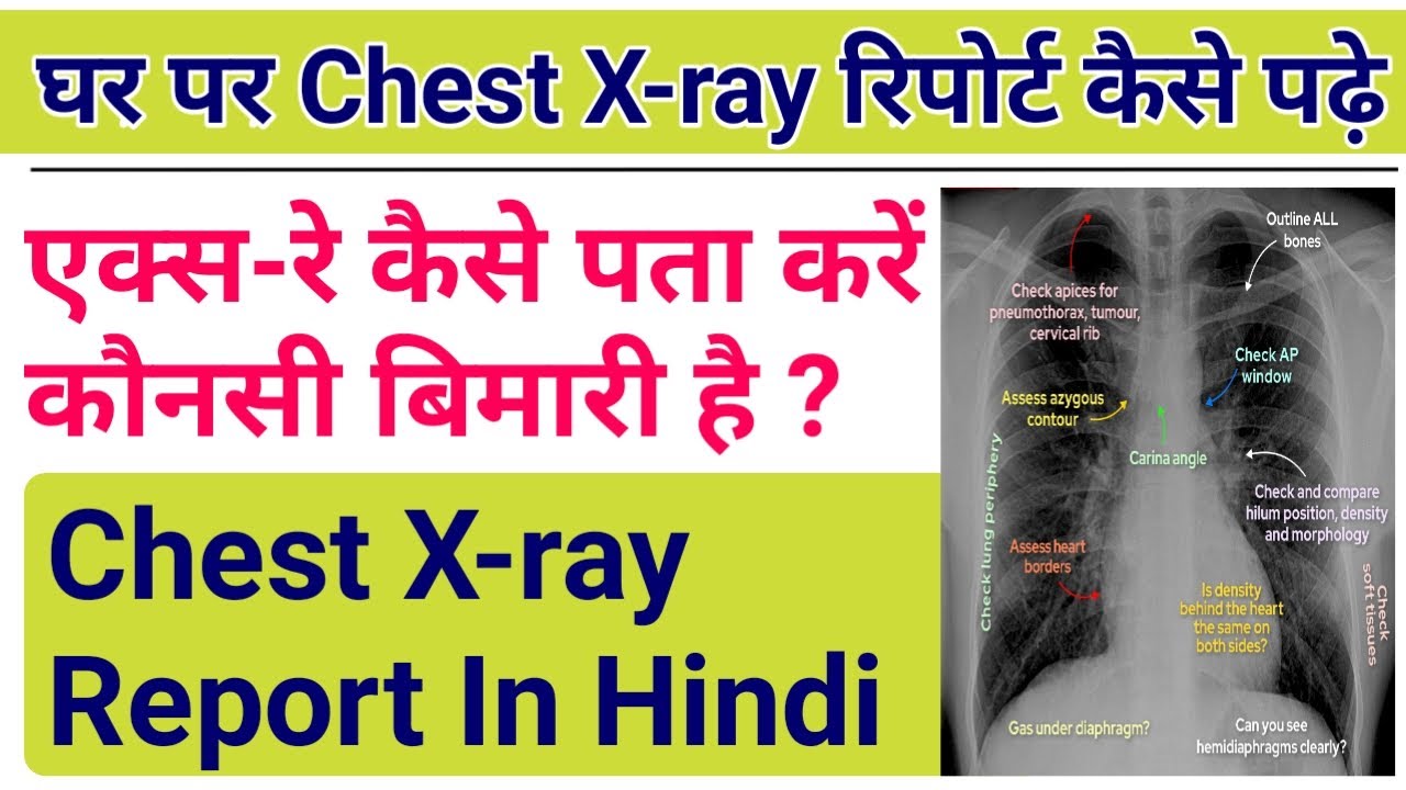 Chest X-ray रिपोर्ट पढ़ना सीखें Chest X ray Report कैसे Read करें ...