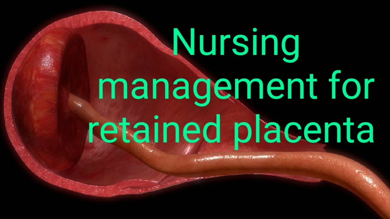 retained placenta #nursing #youtubevideo#obgyn #youtube - YouTube