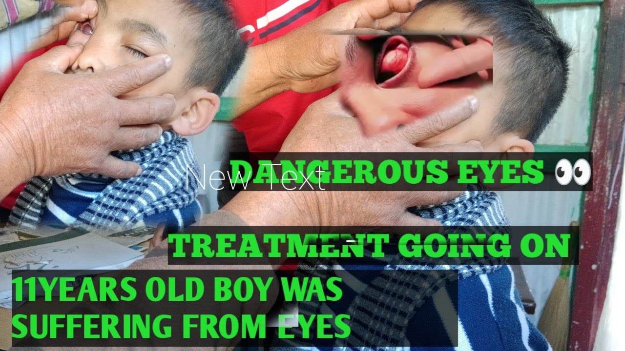 Dangerous Eyes treatment for 11years old boy ...
