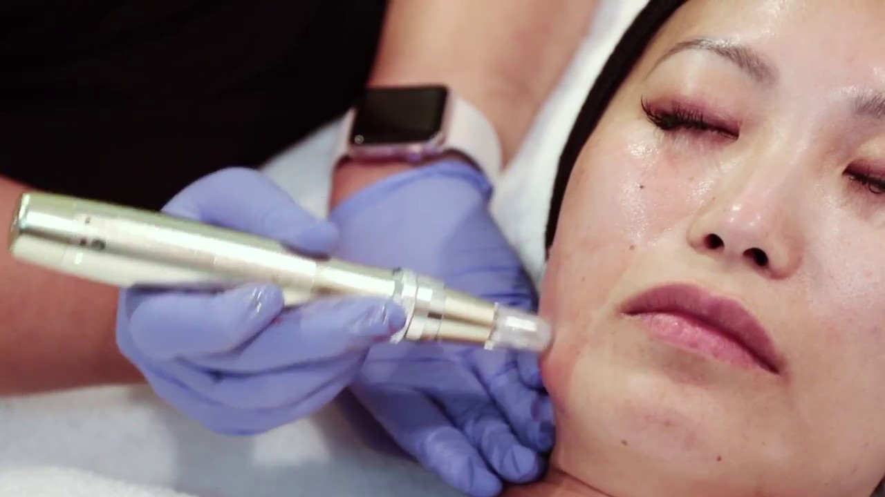 Metropolitan Med Spa Micro Needling with PRP - YouTube