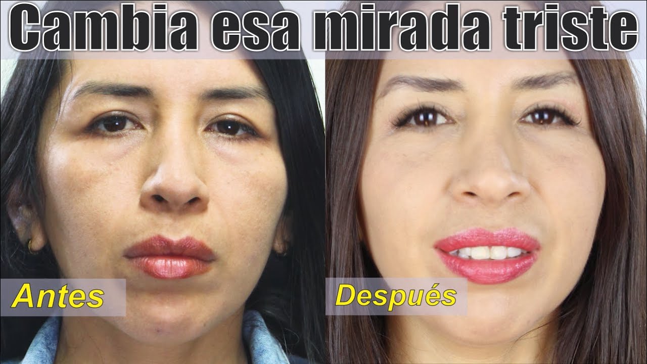 Adiós a la MIRADA CANSADA 👁️ Levantamiento de CEJAS + BLEFAROPLASTÍA ...