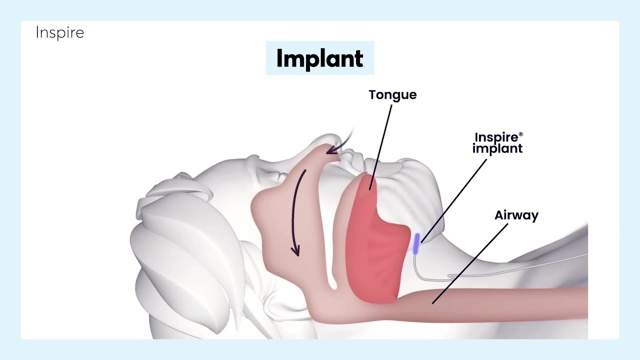 Snore? Sleep apnea treatments go beyond CPAP - YouTube