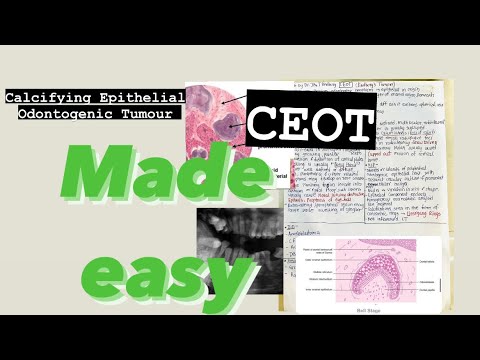 CEOT | Calcifying Epithelial Odontogenic Tumour | 4min