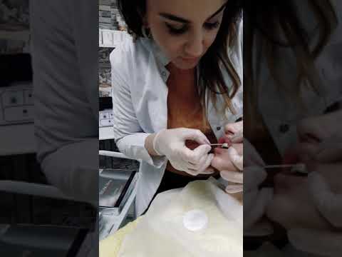 Suni gelin dodaqdan cixarilmasi