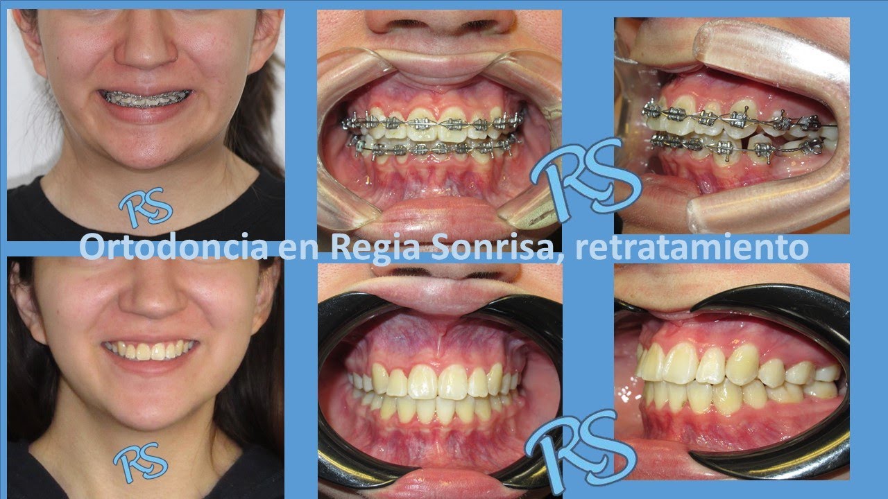 Retratamiento de ortodoncia, en Regia Sonrisa - YouTube