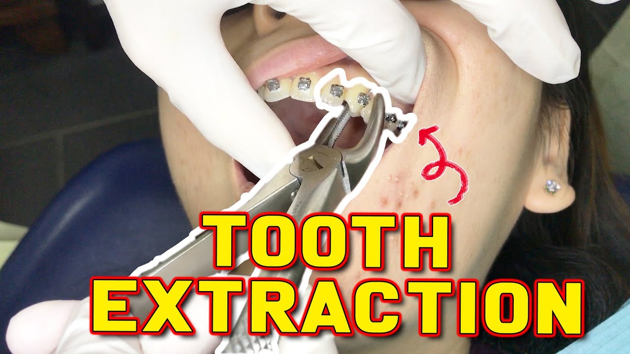 TOOTH REMOVAL!💉🦷 - YouTube