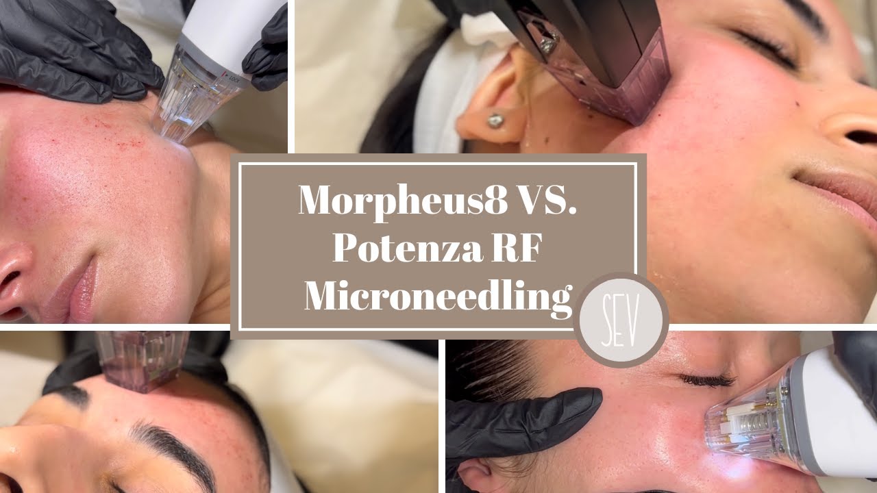 What is the Difference between Morpheus8 and Potenza RF Microneedling at SEV Laser - YouTube
