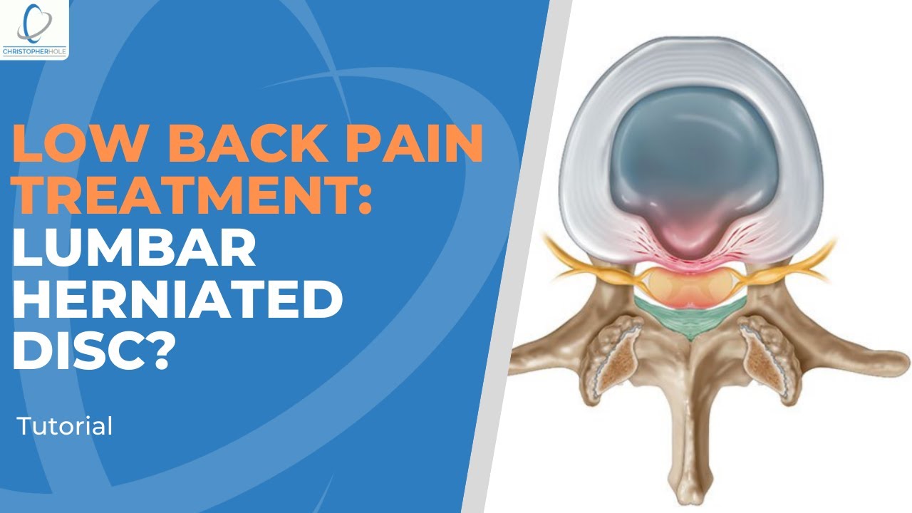 Low Back Pain Treatment: What should I do if I have lumbar herniated ...