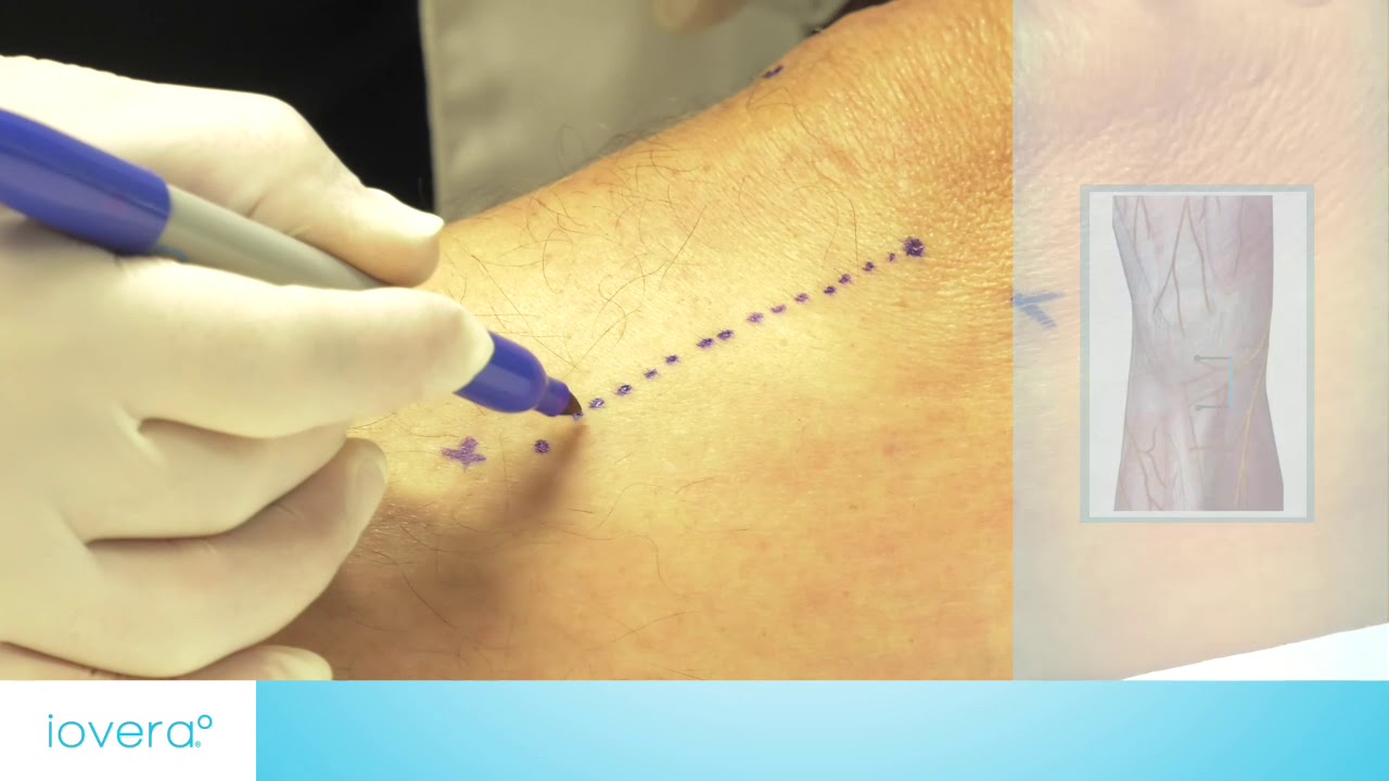 iovera° Treatment Video Condensed - YouTube