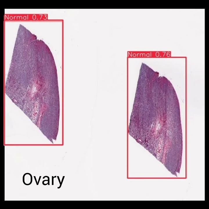 Lung and Ovarian Cancer Detection Yolov8|Computer Vision|Project ...