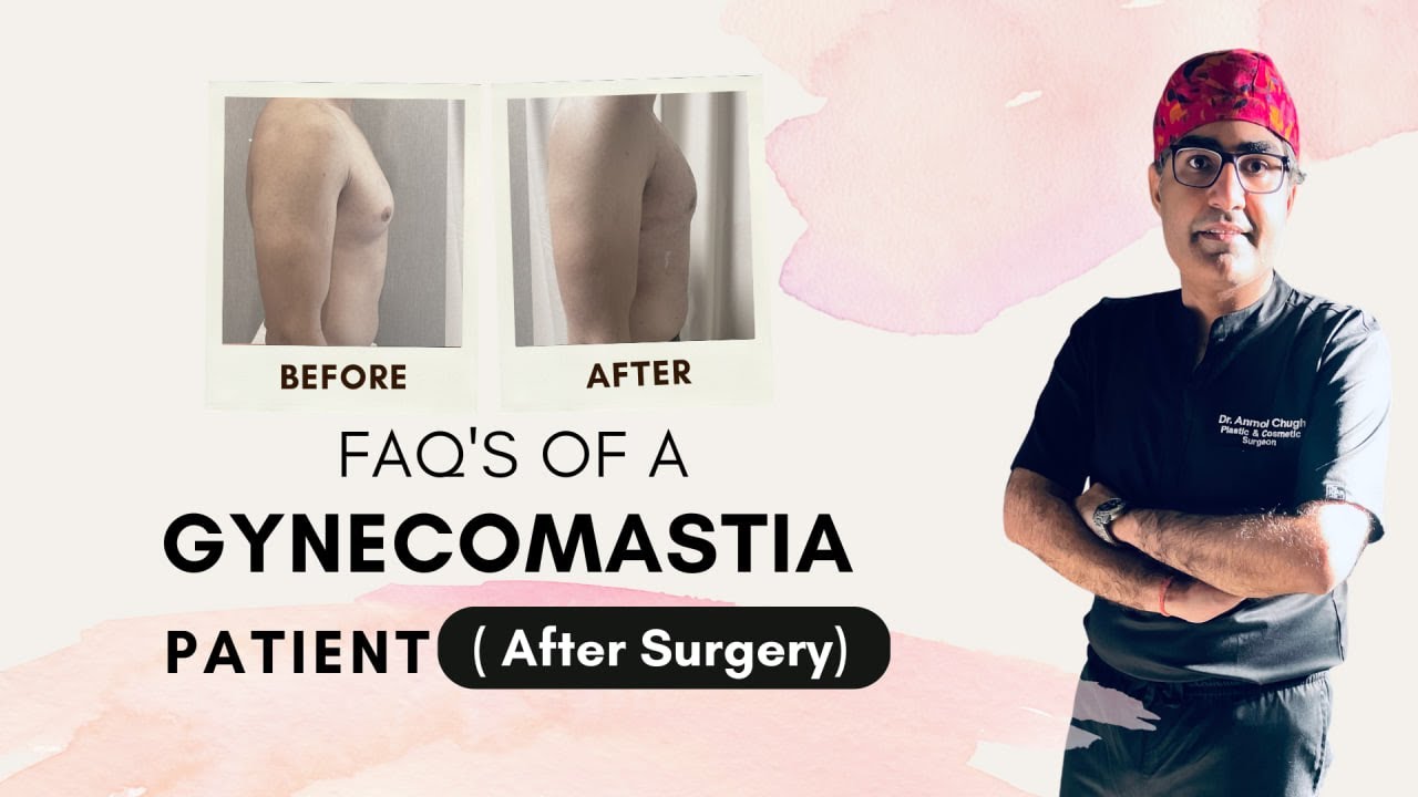 FAQ’s Post Gynecomastia Surgery | Male Chest Reduction Surgery | Best ...
