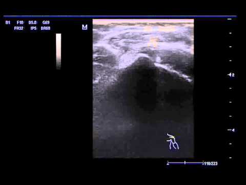 Tendinitis calcificante del tendón subescapular. - YouTube