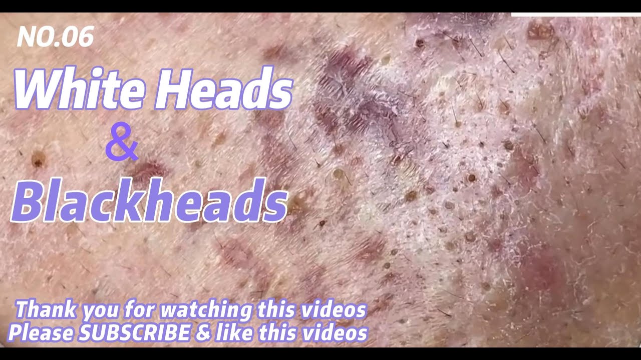 How to removal blackheads on facial with hands #NASA8029 - YouTube
