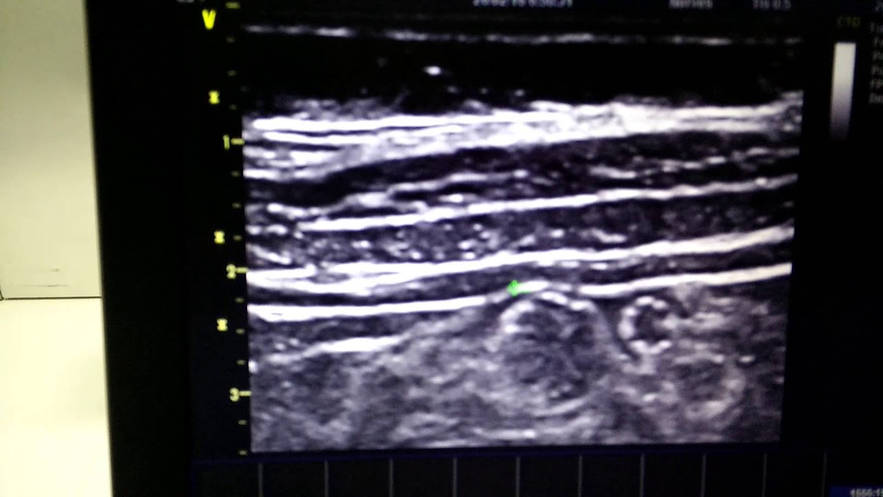 TAP Block US guided. - YouTube