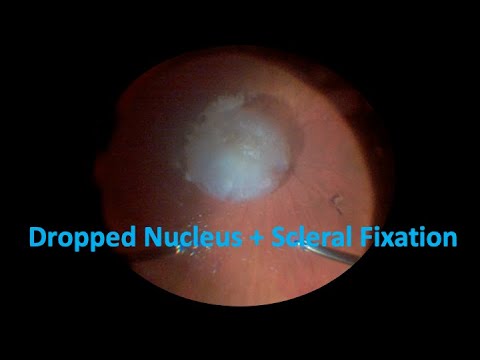 Fragmatome for Dropped Lens + Scleral fixation Akreos IOL - YouTube