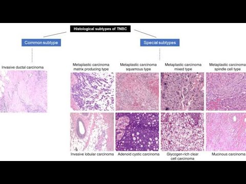 Histological classification of Cancers / Basis of classifying cancers ...