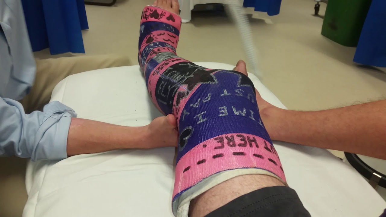 Cast comes off 10weeks... - YouTube