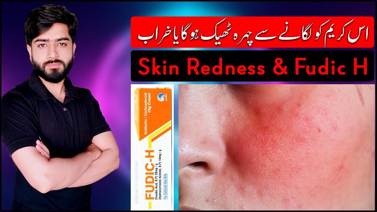 Skin Redness & Fudic H Cream | Fusidic Acid | Hyderocortisone | Beauty ...
