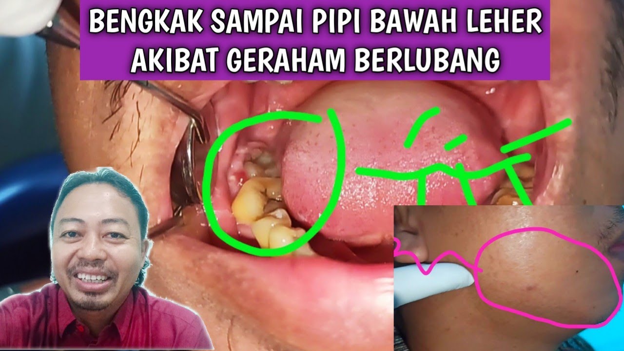 Gara Gara Geraham Berlubang Penyebab Infeksi Dan Bengkak Pipi Sampai Ke ...