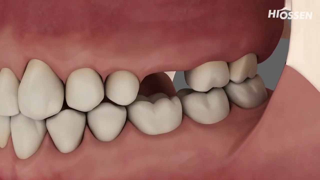 OSSTEM CAS Kit Crestal Approach Sinus Kit - YouTube