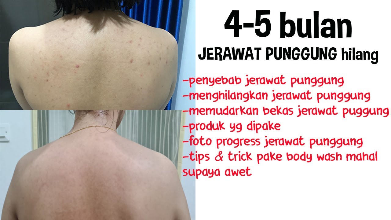 Menghilangkan Jerawat Punggung Youtube