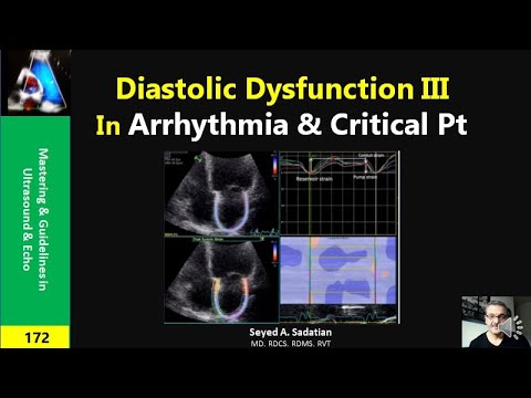 Diastolic Dysfunction III in Arrhythmia & Critical Pts - YouTube
