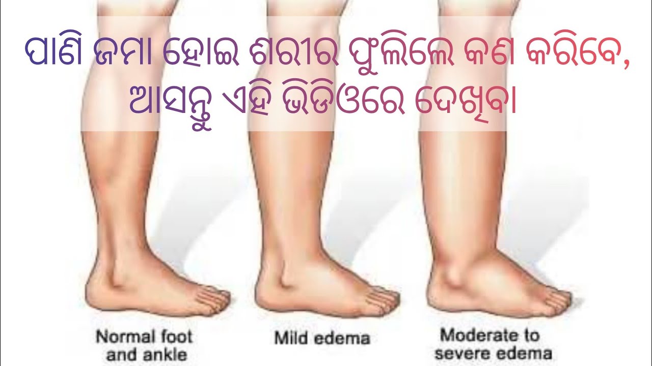 Edema : Water Retention in Whole Body- Swelling of Limbs : Acupressure ...