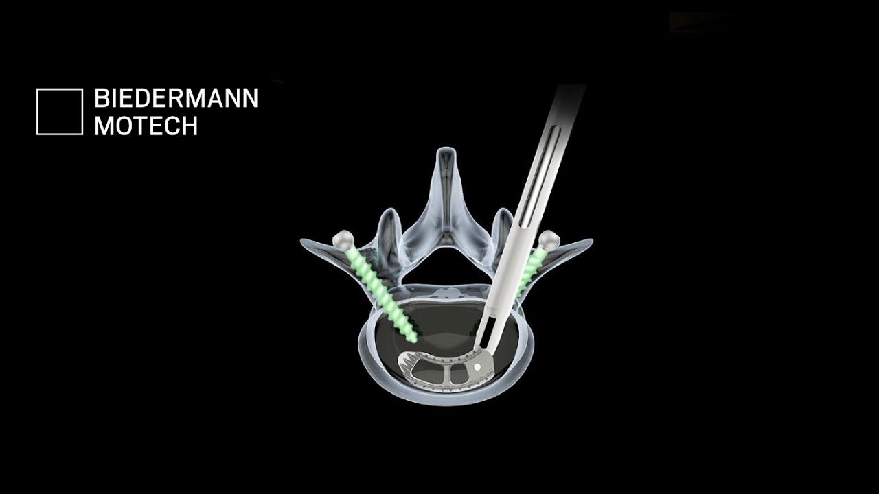 Biedermann Motech: TELIX K® Steerable TLIF - YouTube