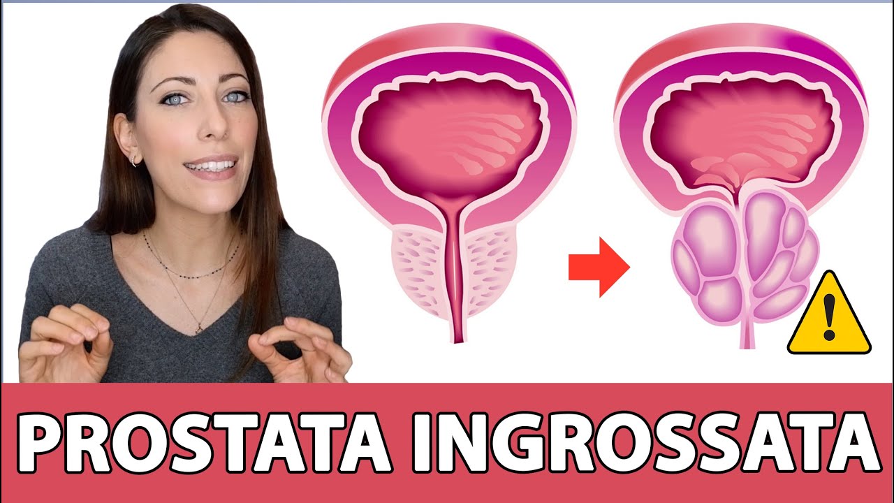 ⚠️ Ipertrofia Prostatica Benigna Come Prevenire E Affrontare L