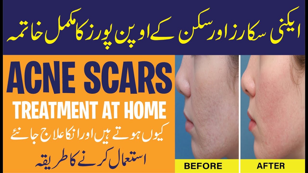 Acne Scars Removal How To Remove Acne Scars Acne Scars Home Remedies Youtube
