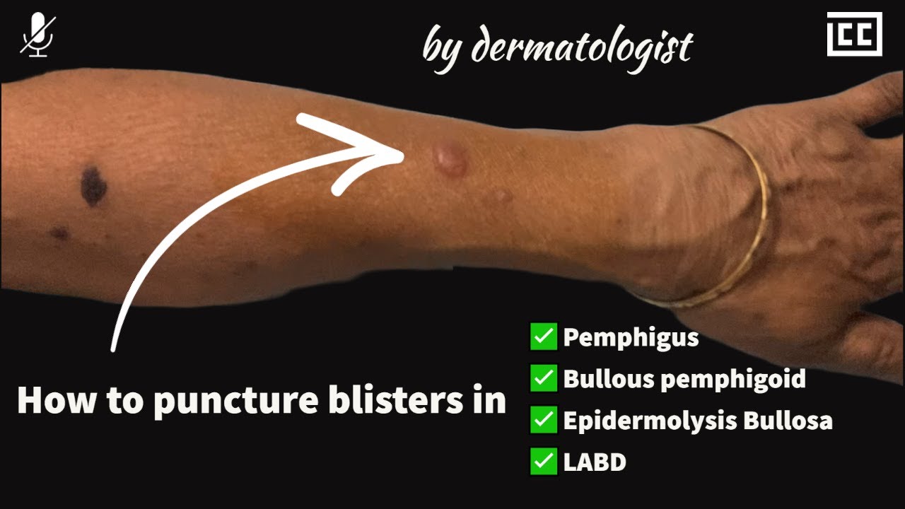 How to take care of unbroken blister in feet , hand & toe ?| Puncture ...
