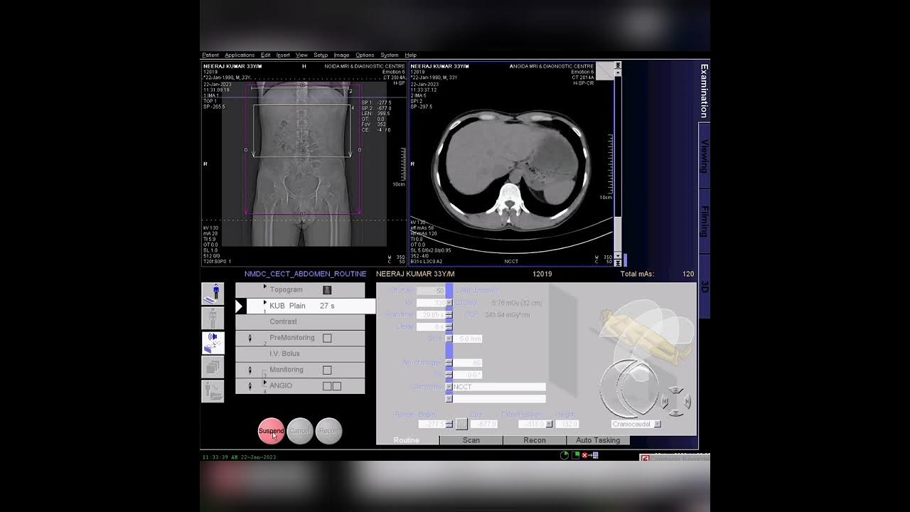 Ct scan Angiography in Siemens Bolus - YouTube