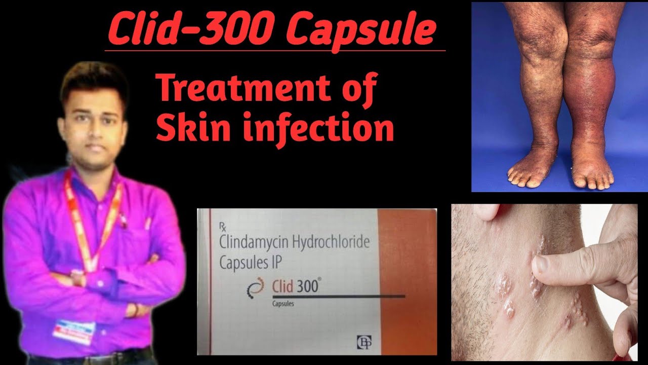 Clindamycin 300 mg capsule uses | Clindamycin side effects ...