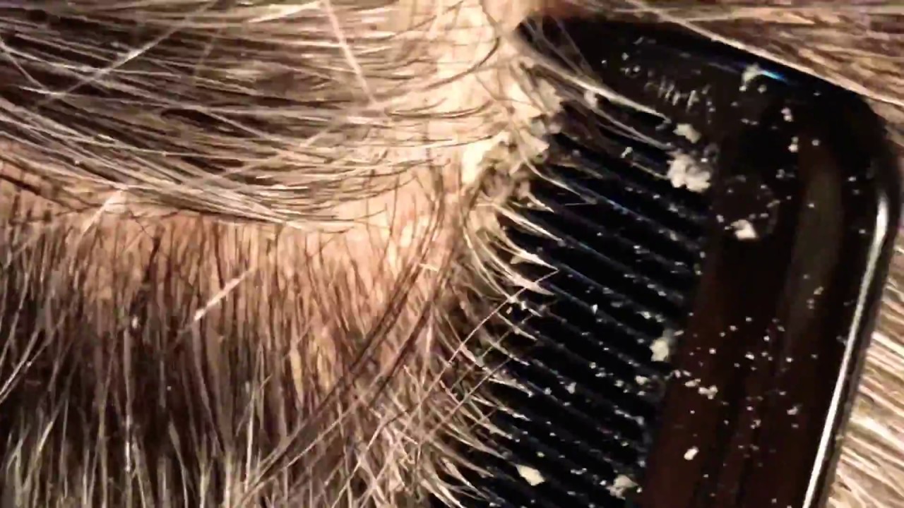 Big Dandruff Flakes Scratching With Comb - YouTube
