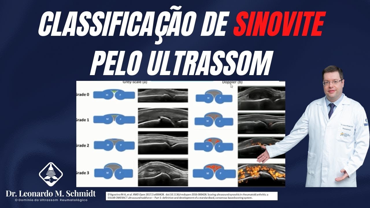 Como Classificar SINOVITE conforme EULAR-OMERACT? - YouTube