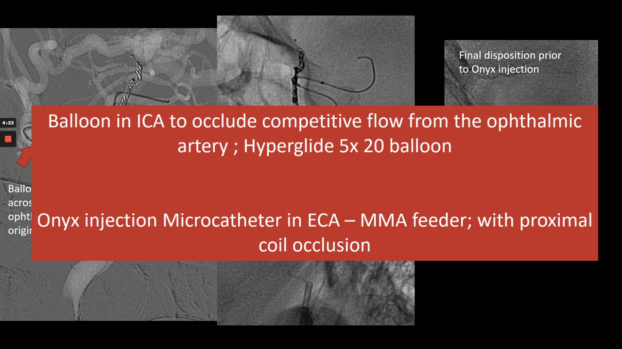 Dural AVF: The pressure cooker technique. - YouTube