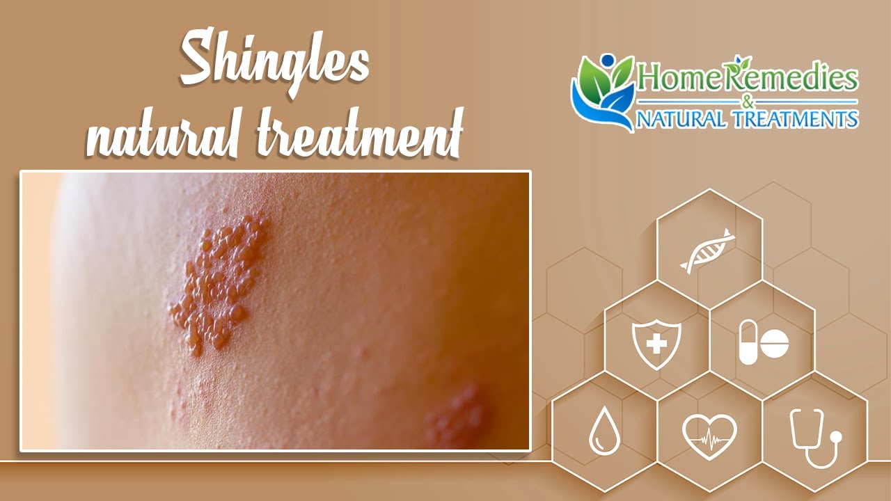 Natural treatments and home remedies for shingles. - YouTube