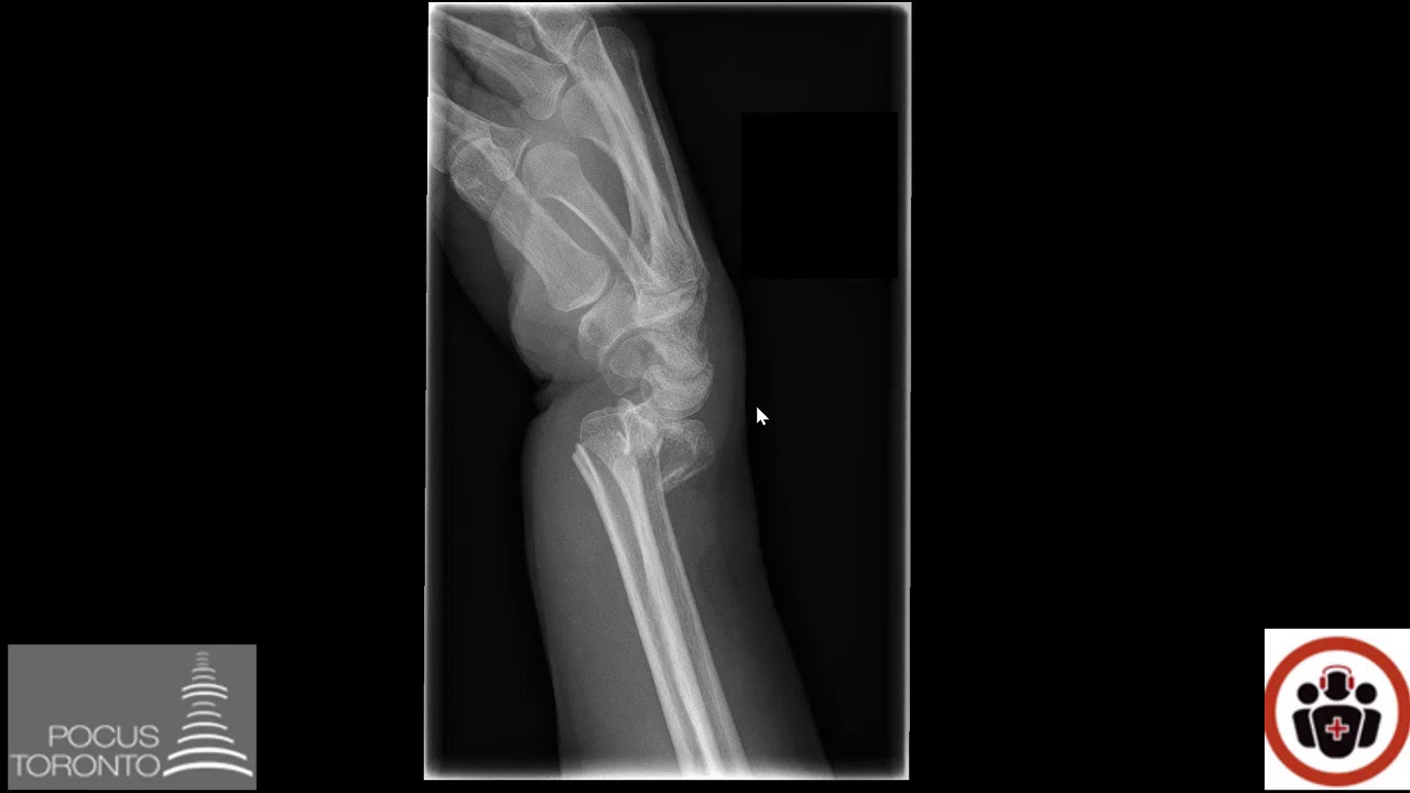 POCUS Cases 4: Distal Radius Fracture - YouTube