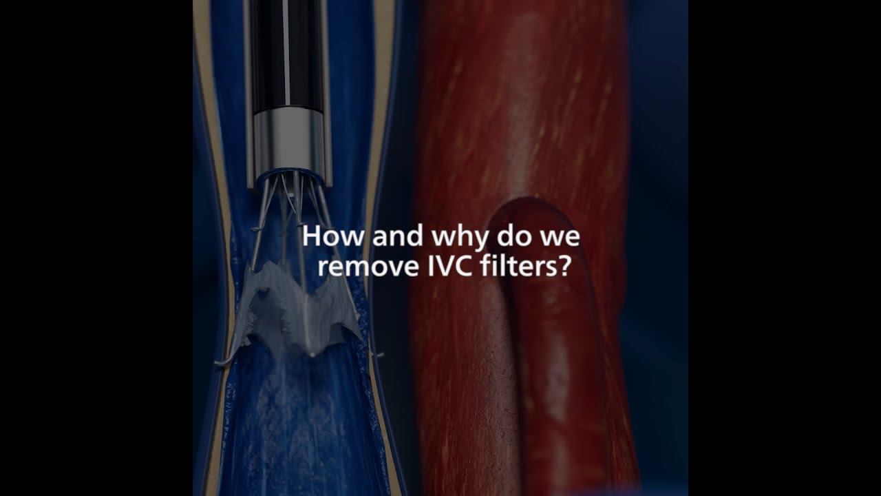 How and why do we remove IVC filters - Get in the know with Dr. Atul ...