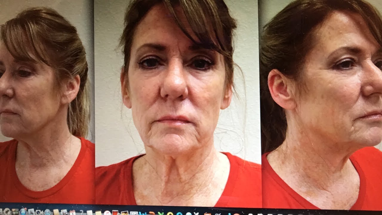 Yes to facial Fillers, NO to Chipmunk Cheeks 💉 - YouTube