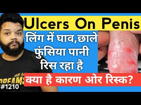 Penis Ulcer & Pimples Causes In Hindi | Genital Ulcer In Hindi