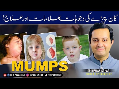 MUMPS SYMPTOMS & HOME TREATMENT #Mumps #treatment