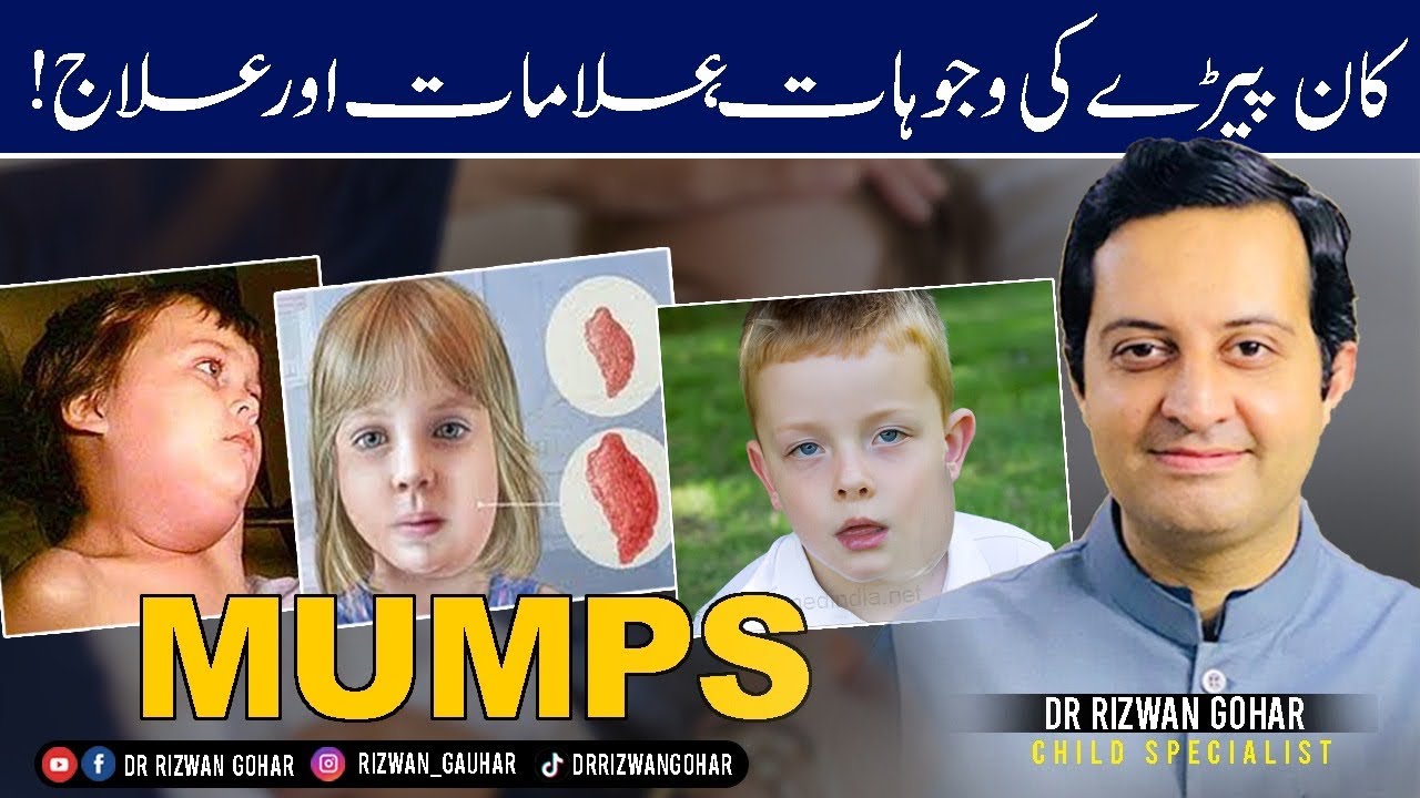 MUMPS SYMPTOMS & HOME TREATMENT #Mumps #treatment - YouTube