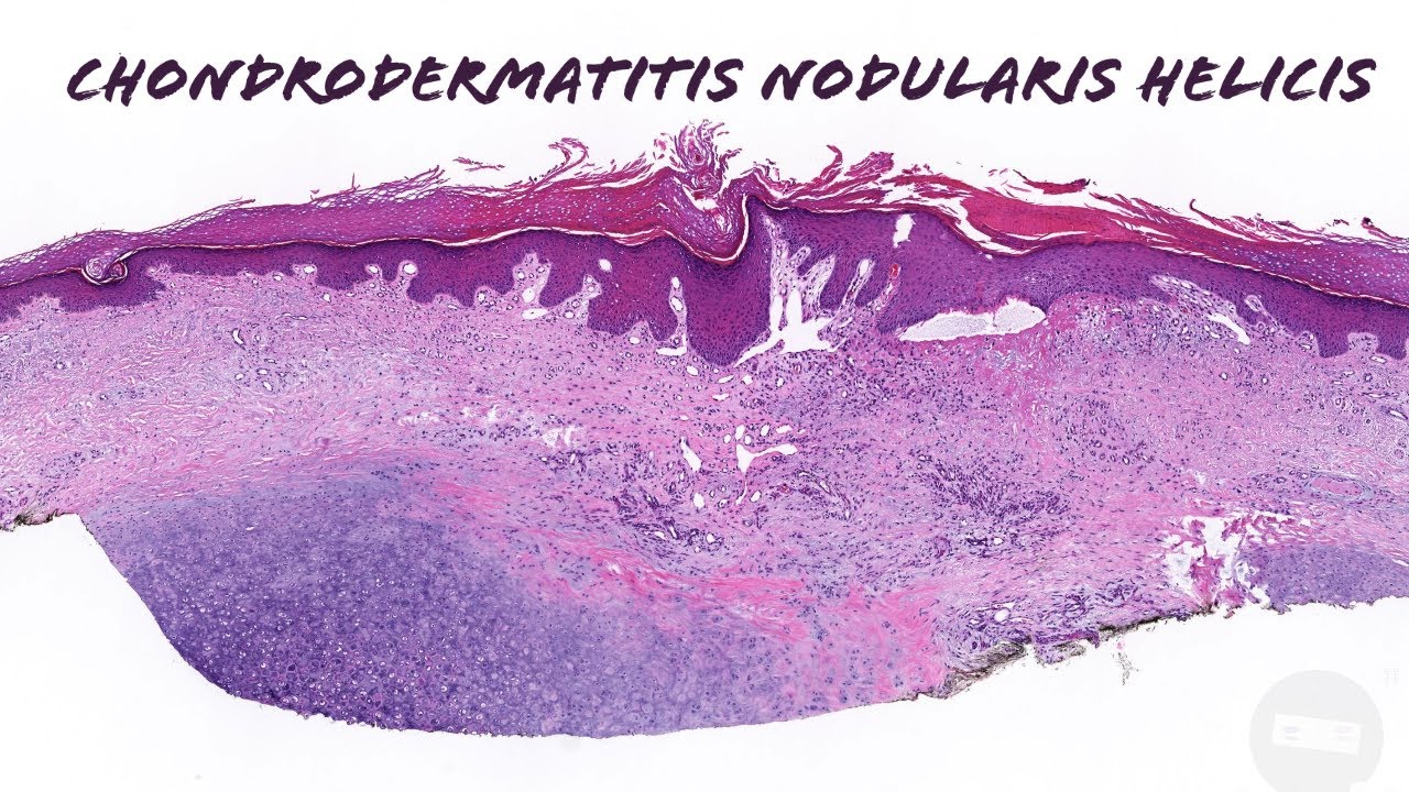 CNH (chondrodermatitis nodularis helicis) pathology histology dermpath ...