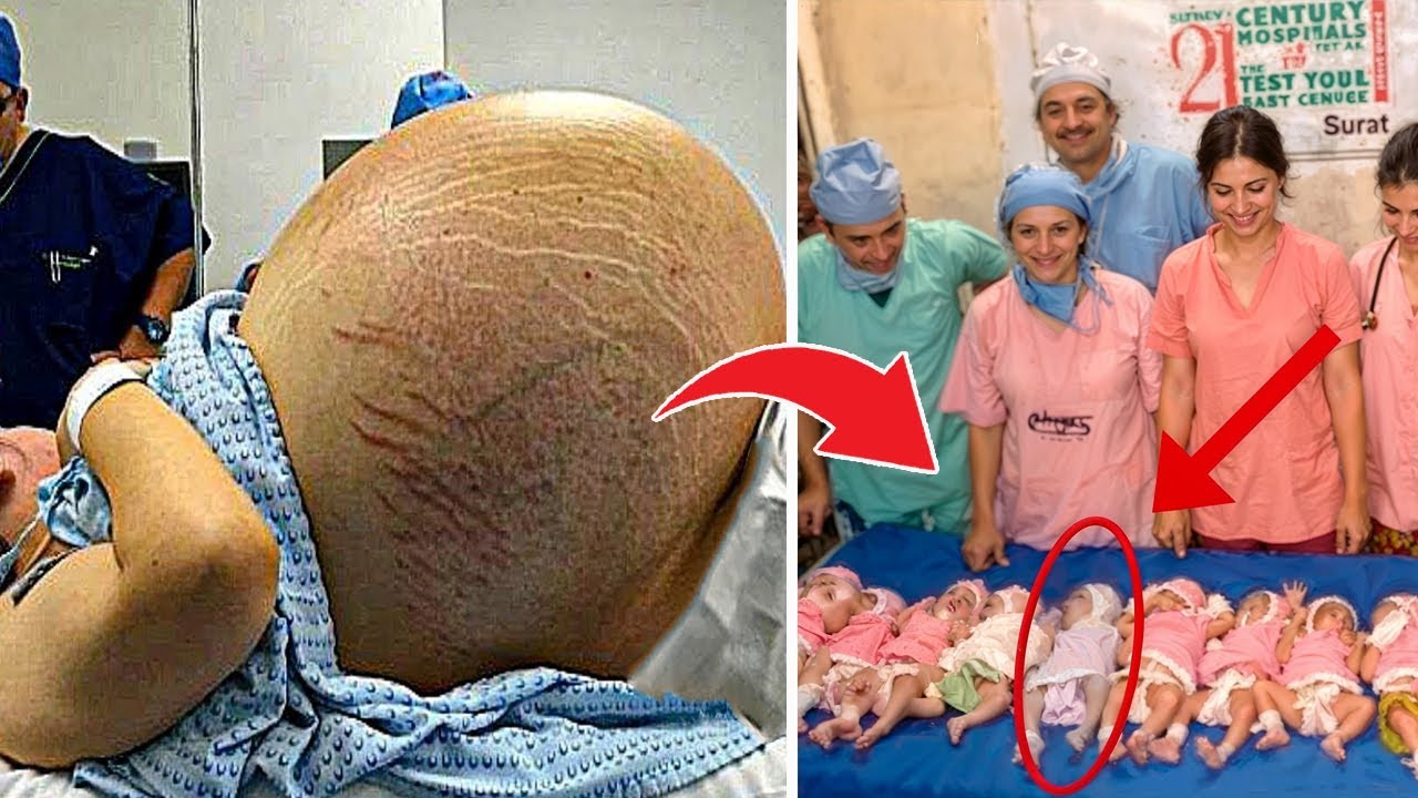 The Woman Set the Record For The World's Biggest Belly, and In It Were ...