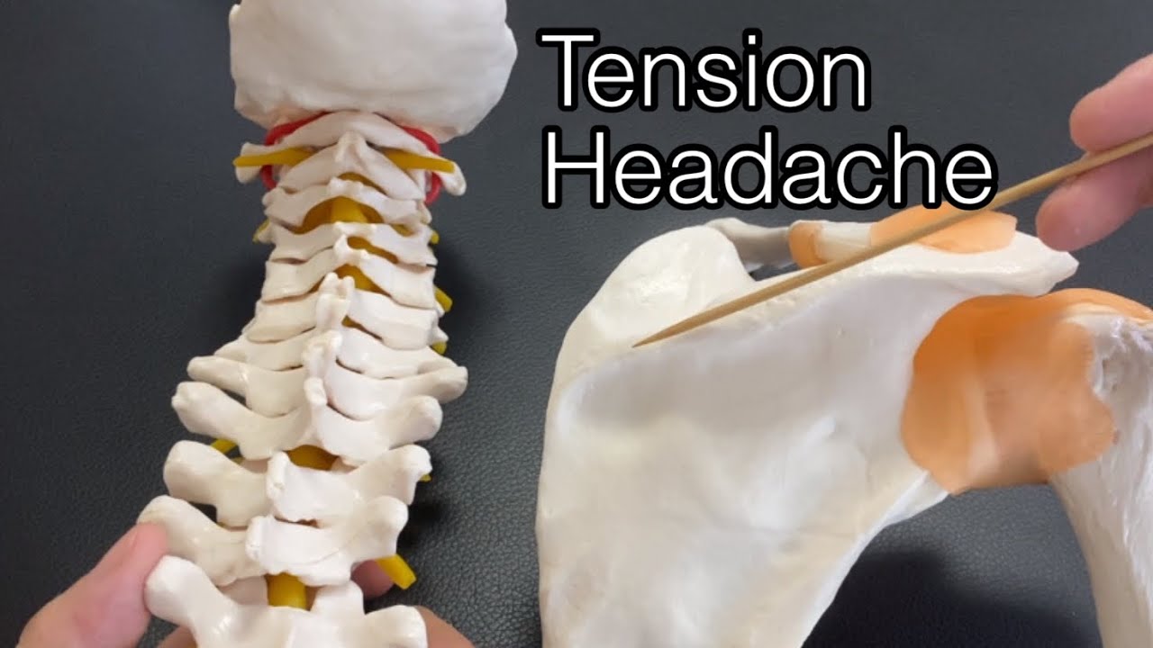 Mechanics and cause of tension headache (English) - YouTube